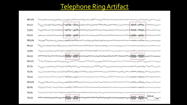Eeg Artifact And How To Resolve Pptx