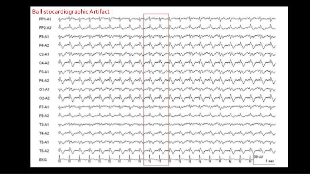 EEG Artifact and How to Resolve
