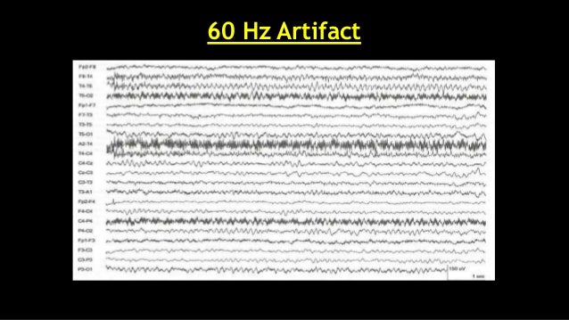 EEG Artifact and How to Resolve