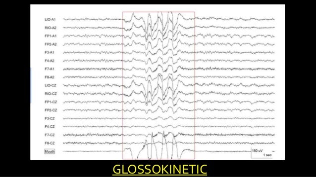 EEG Artifact and How to Resolve