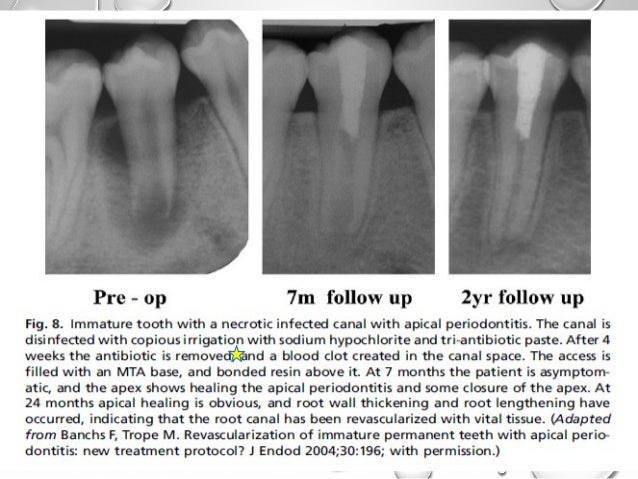 Regenerative endodontics