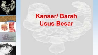 Barah Usus Besar by Dr. Fitjerald Henry.ppt