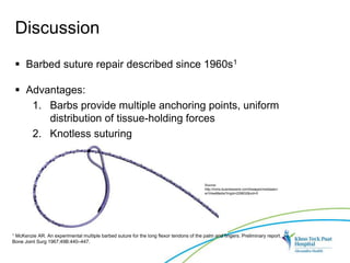 Barbed sutures | PPTX