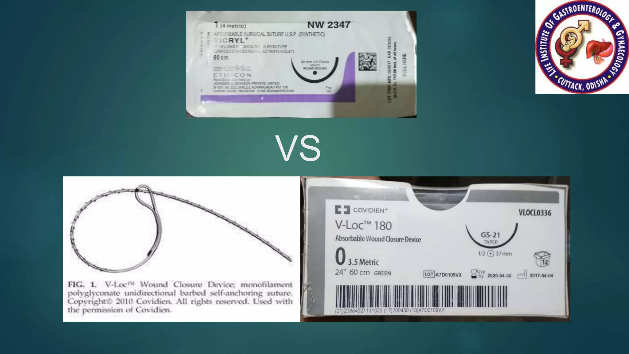 Barb suture use in total laparoscopic hysterectomy | PPTX
