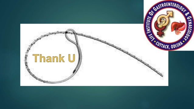 Barb suture use in total laparoscopic hysterectomy | PPT