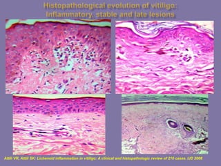 ACROFACIAL VITILIGO | PPTX