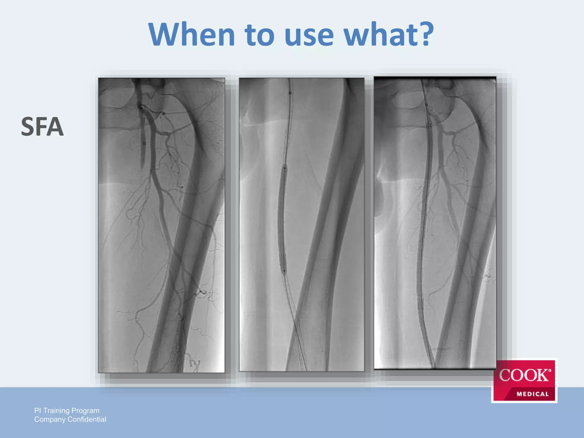 Bare-Metal-Stent-Self-Expandable-stent-balloon-expandable-stent.pptx