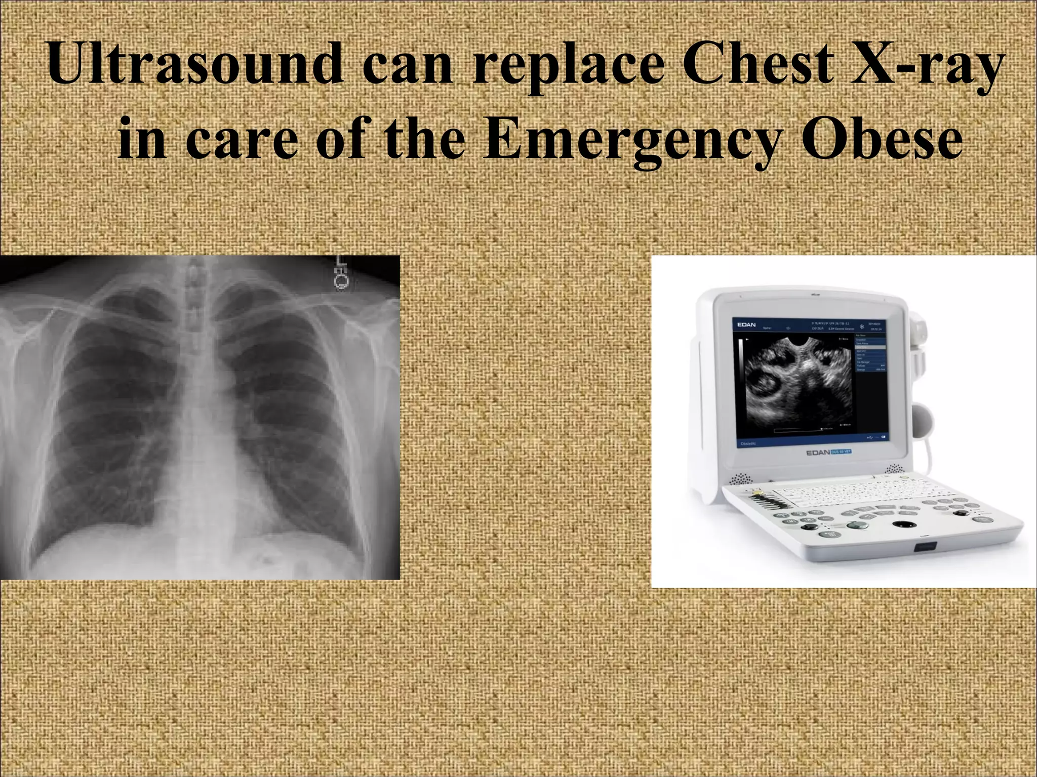 Chest USG vs CXR in Emergency Obese | PPT