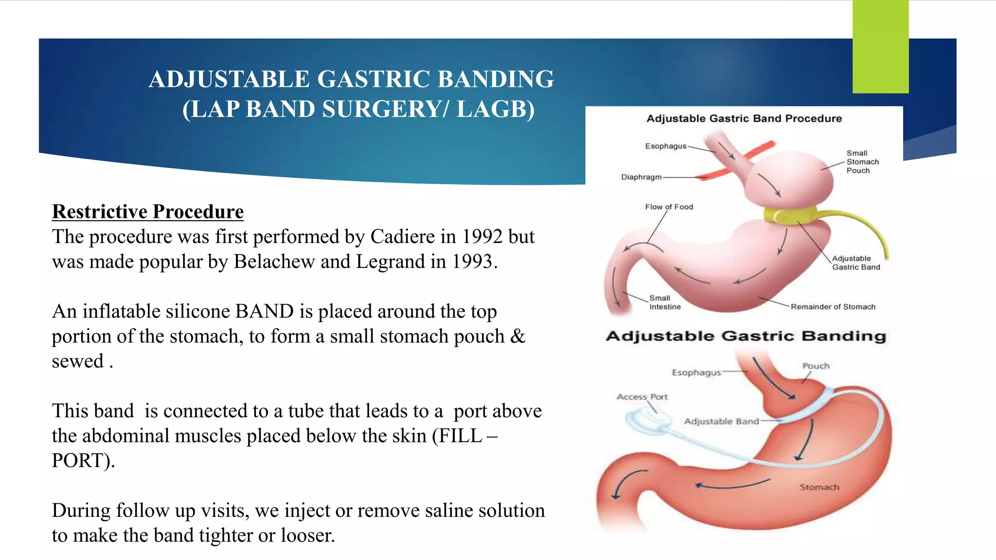 Bariatric surgery | PPTX