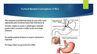 Vertical Banded Gastroplasty