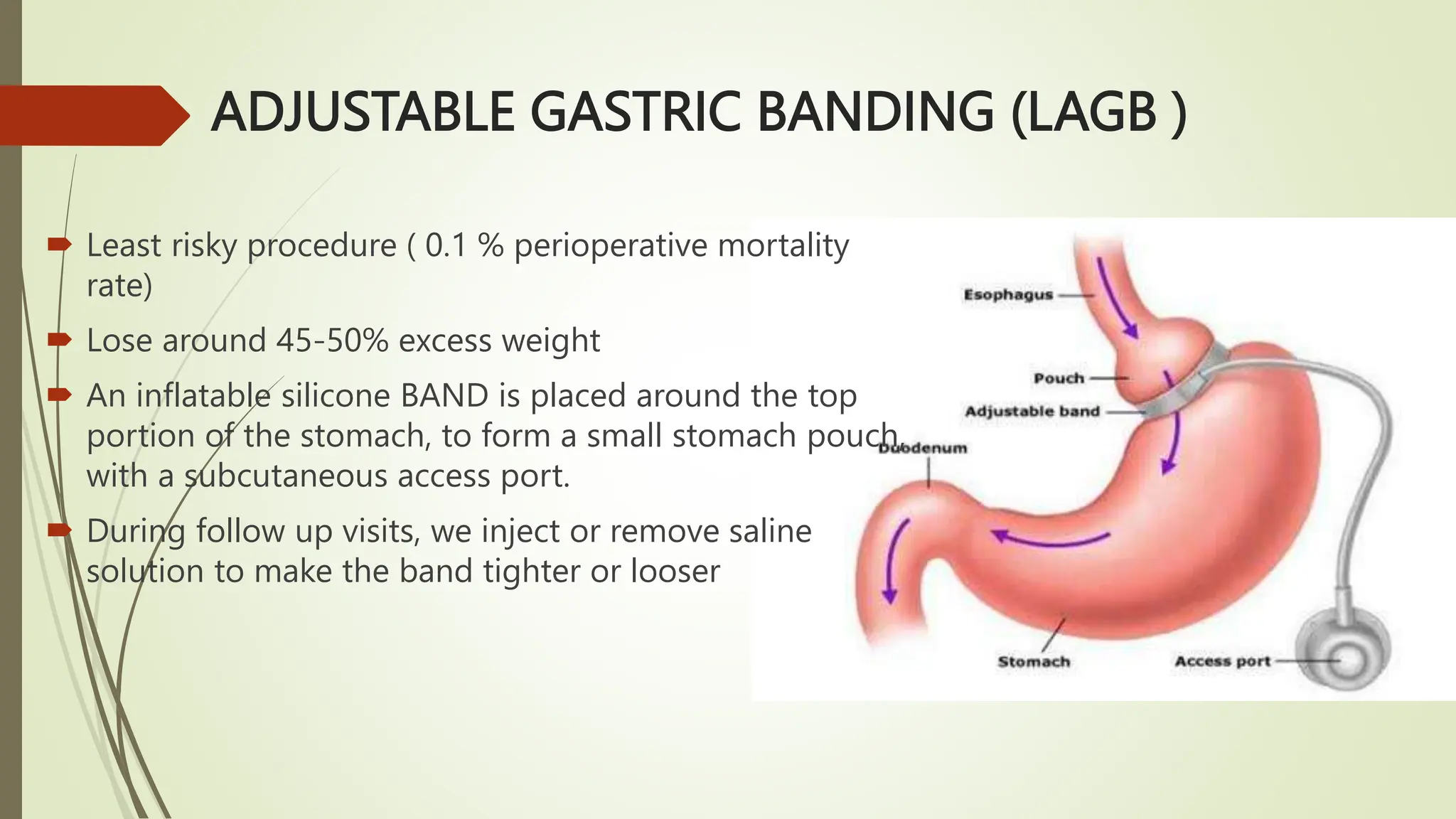 Bariatric surgery by Dr Muhammad Naeem Yousaf.pptx