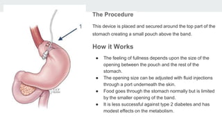 Bariatric Surgery (1).pptx