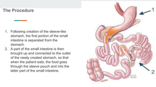 Bariatric Surgery (1).pptx