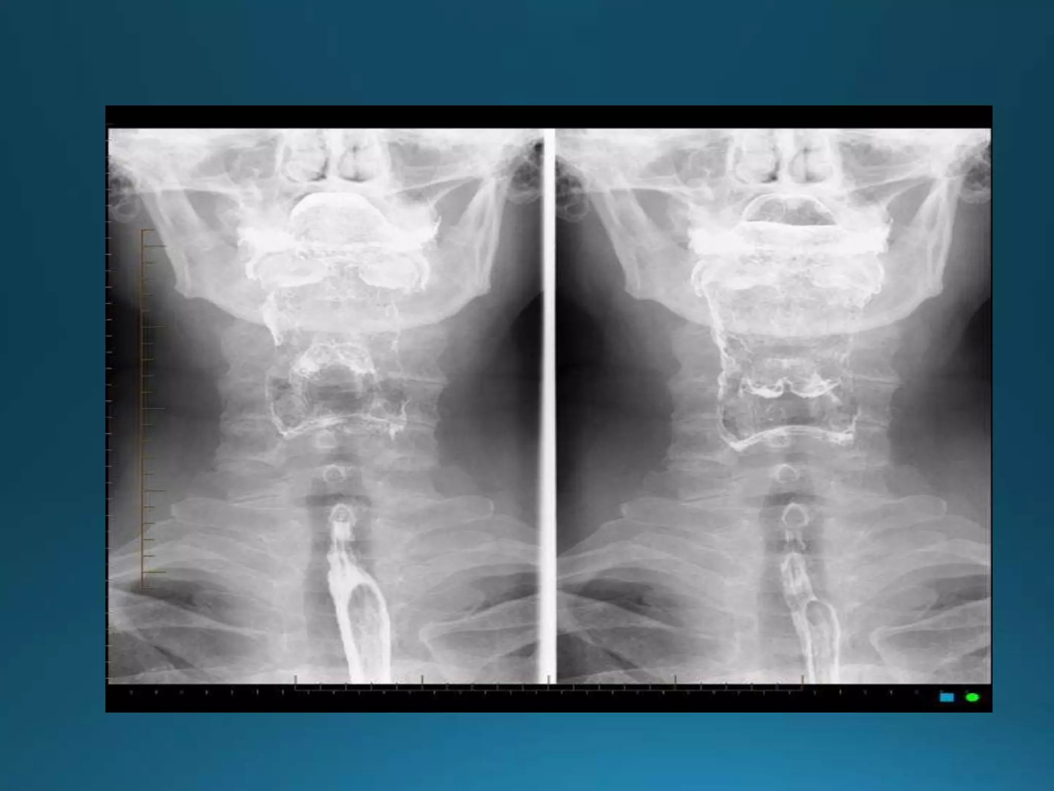 Basics of Barium Imaging | PPTX