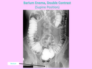 Barium enema | PPTX