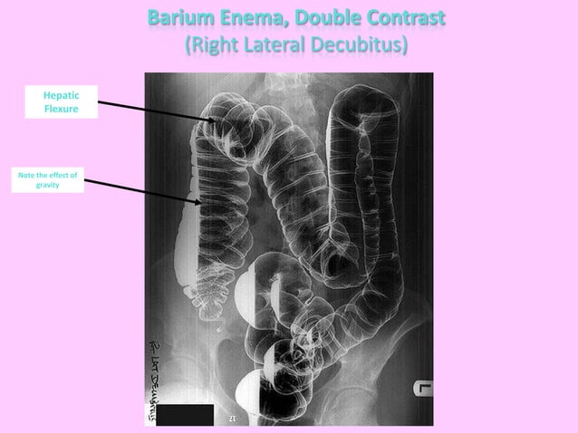 Barium enema