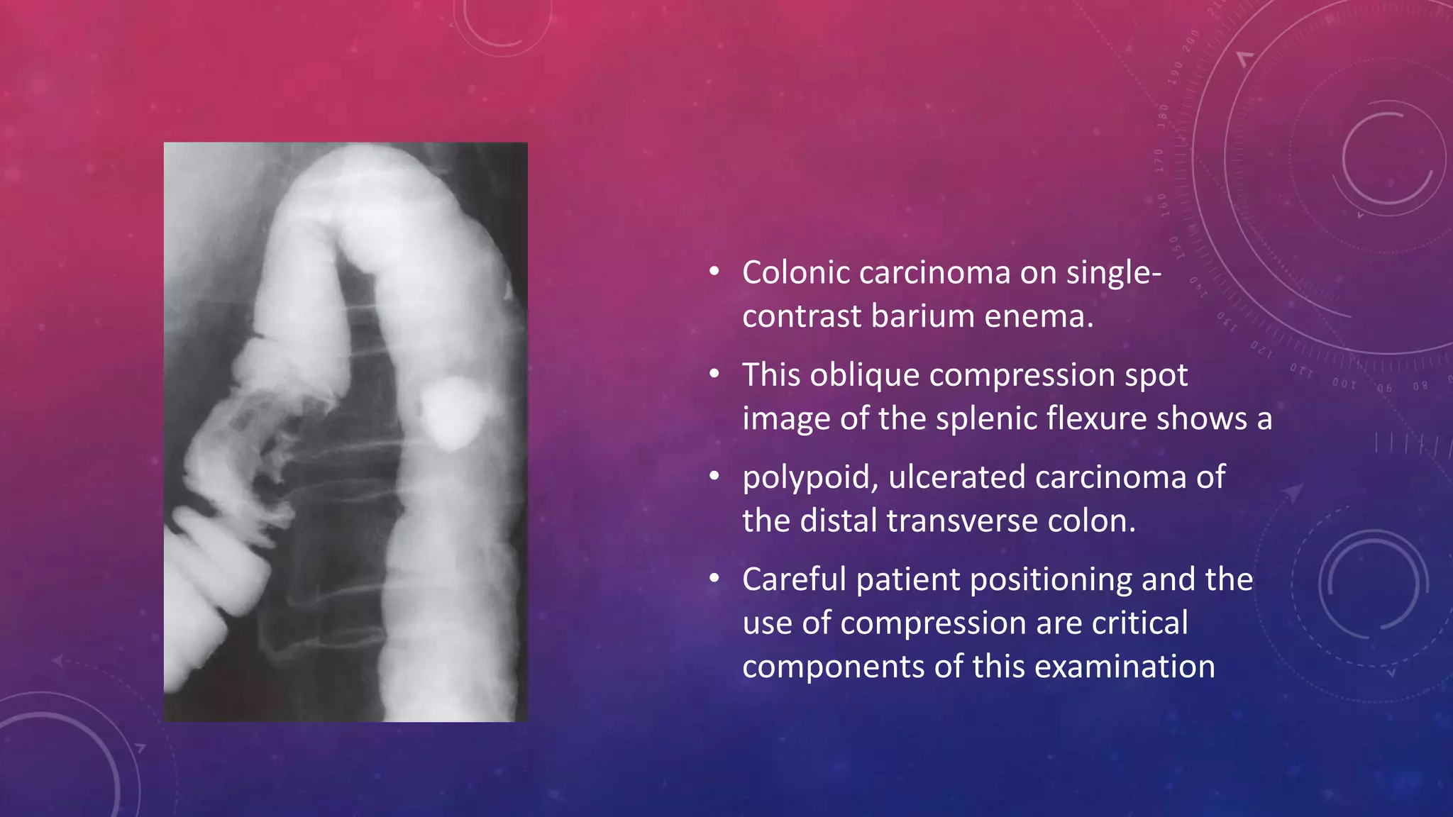 Barium enema | PPTX