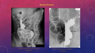 Barium enema | PPTX