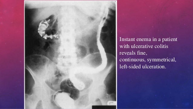 Barium Enema Treatment| Kent – HHCT