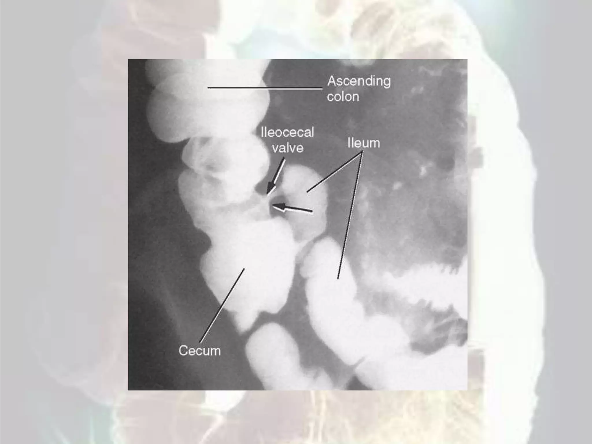 Barium enema | PPT