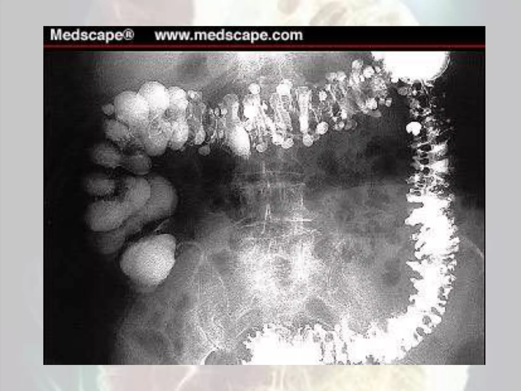 Barium enema | PPT