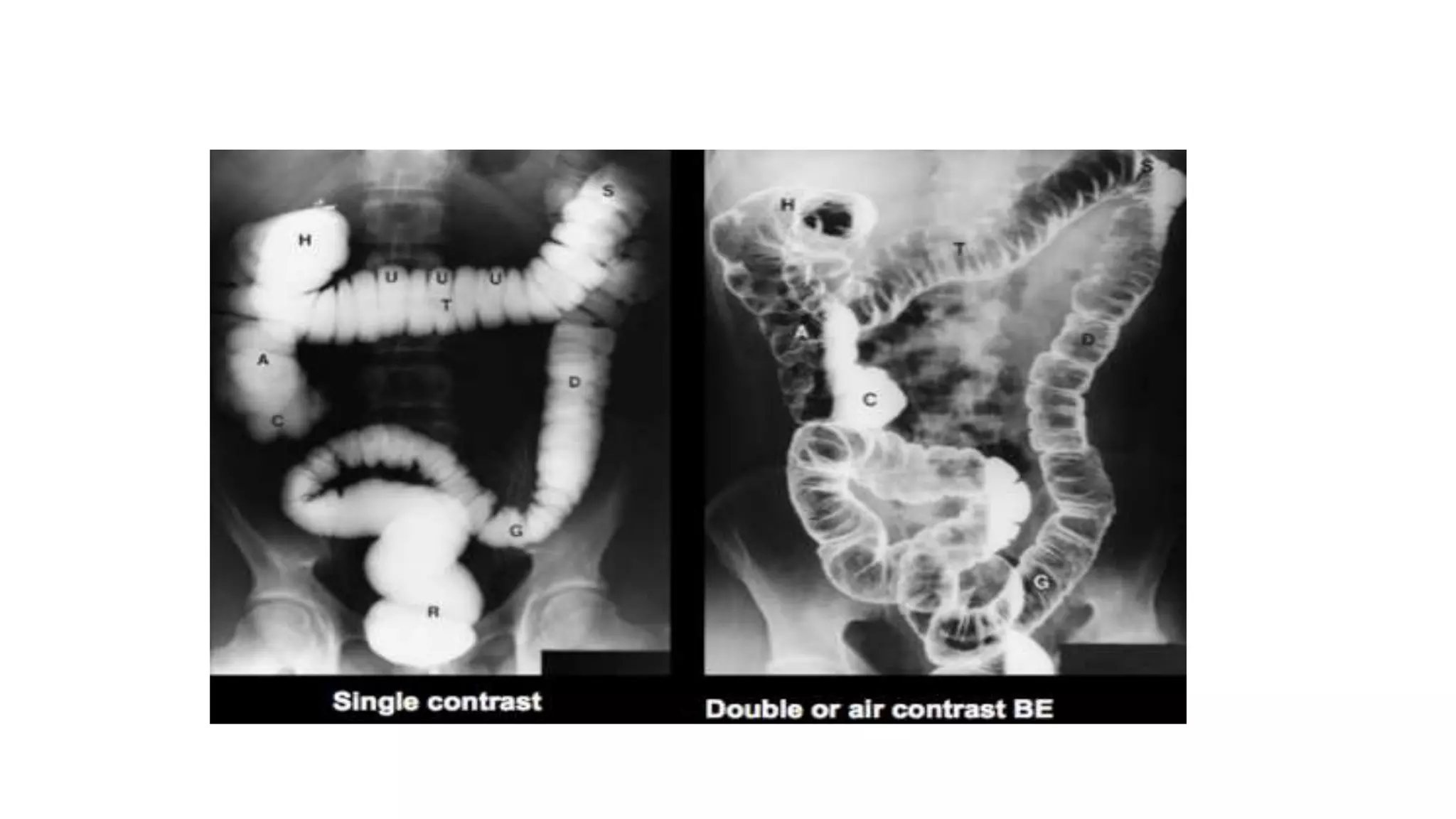 BARIUM ENEMA | PPTX