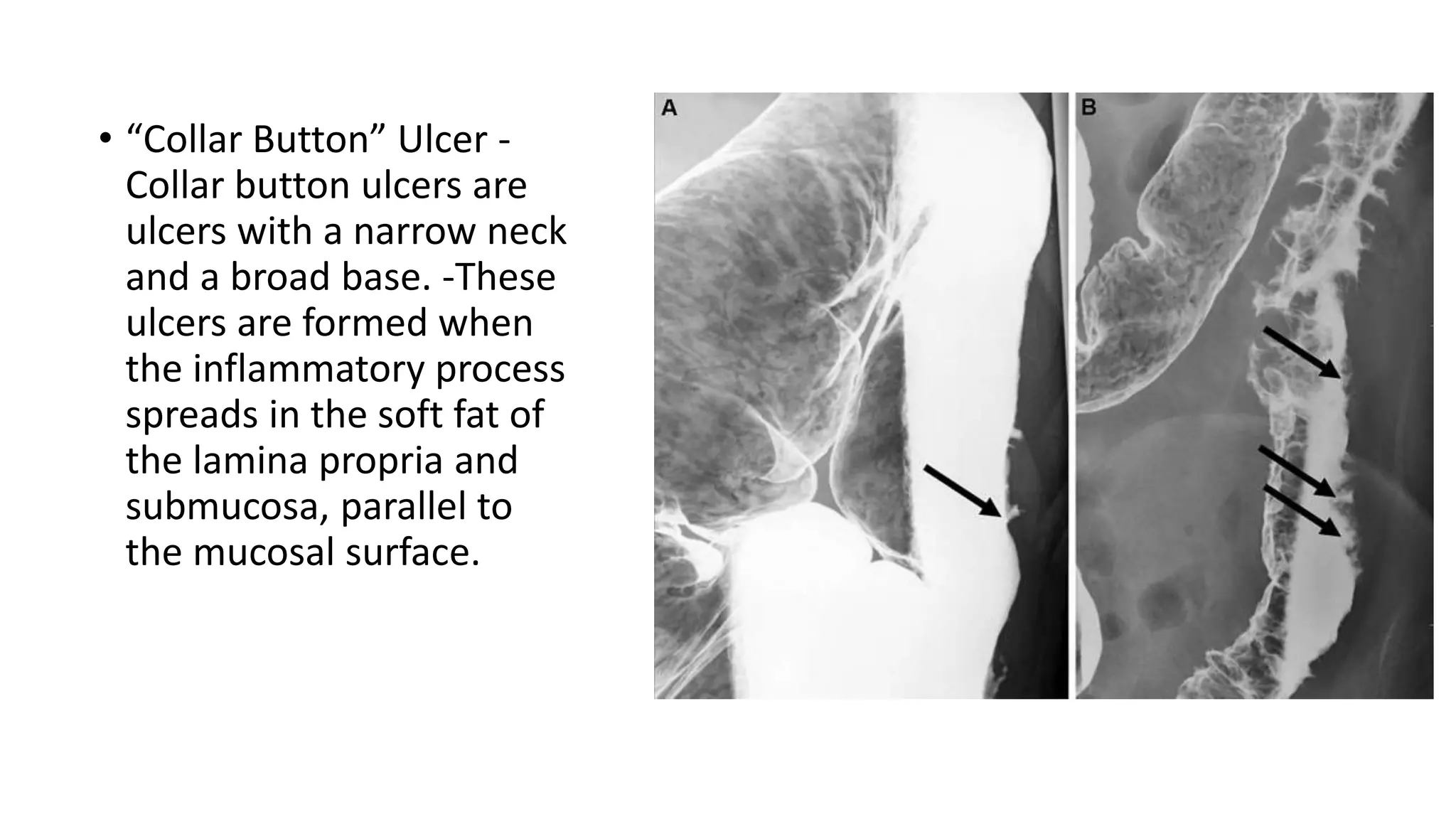 BARIUM ENEMA | PPTX