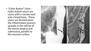 BARIUM ENEMA | PPTX