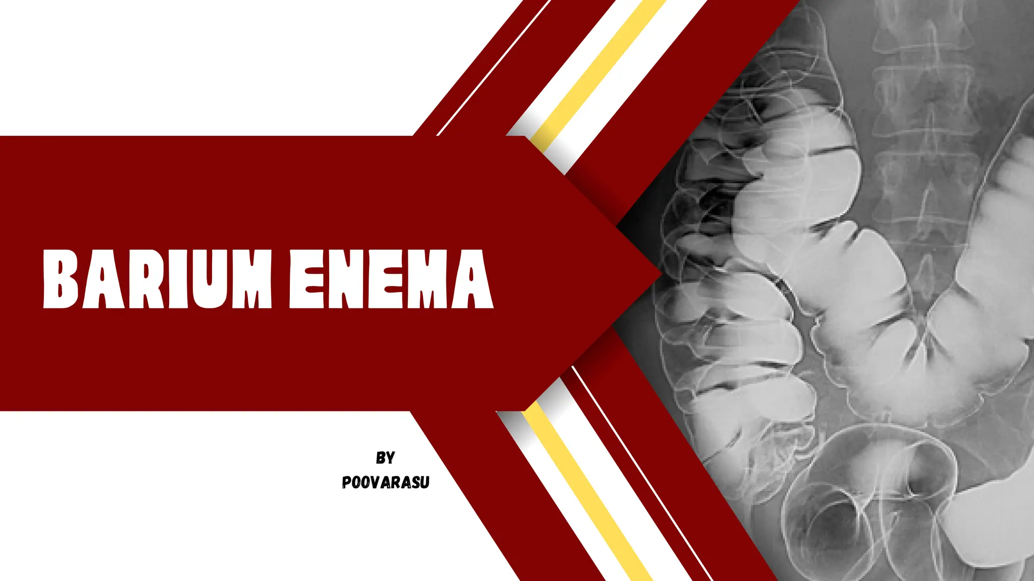 Barium Enema procedure in radiology department | PDF