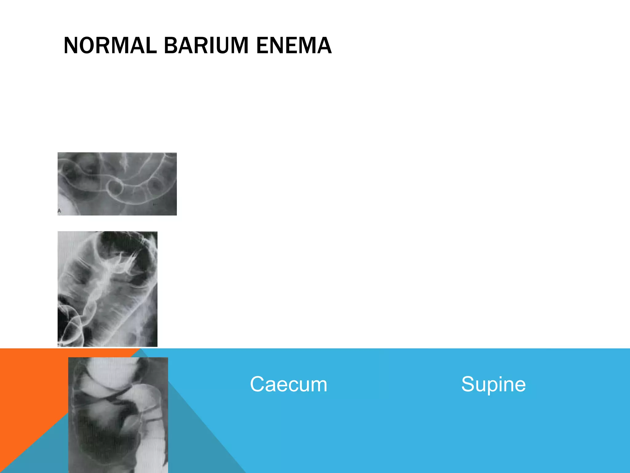Barium enema ppt | PPTX