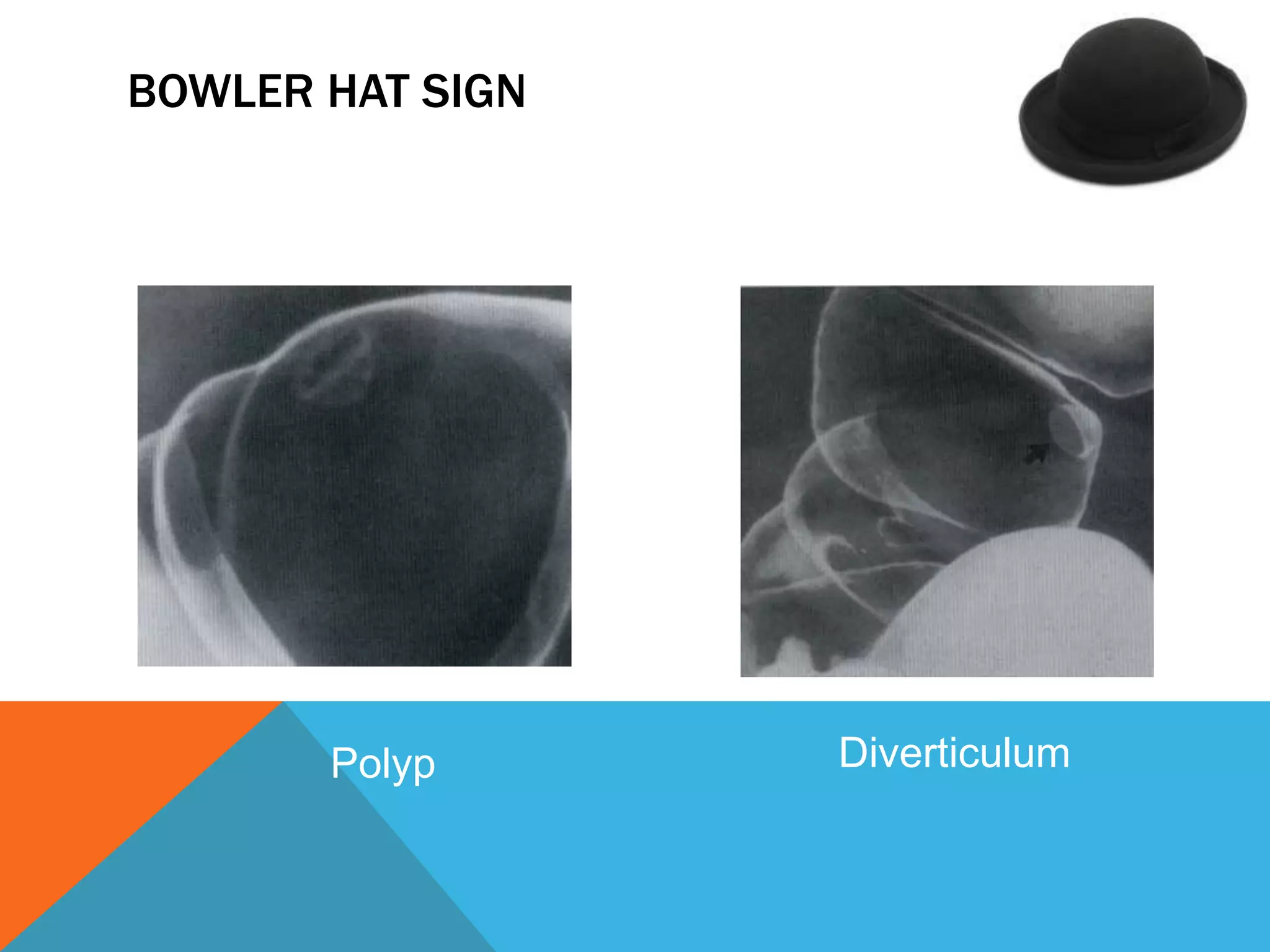Barium enema ppt | PPTX