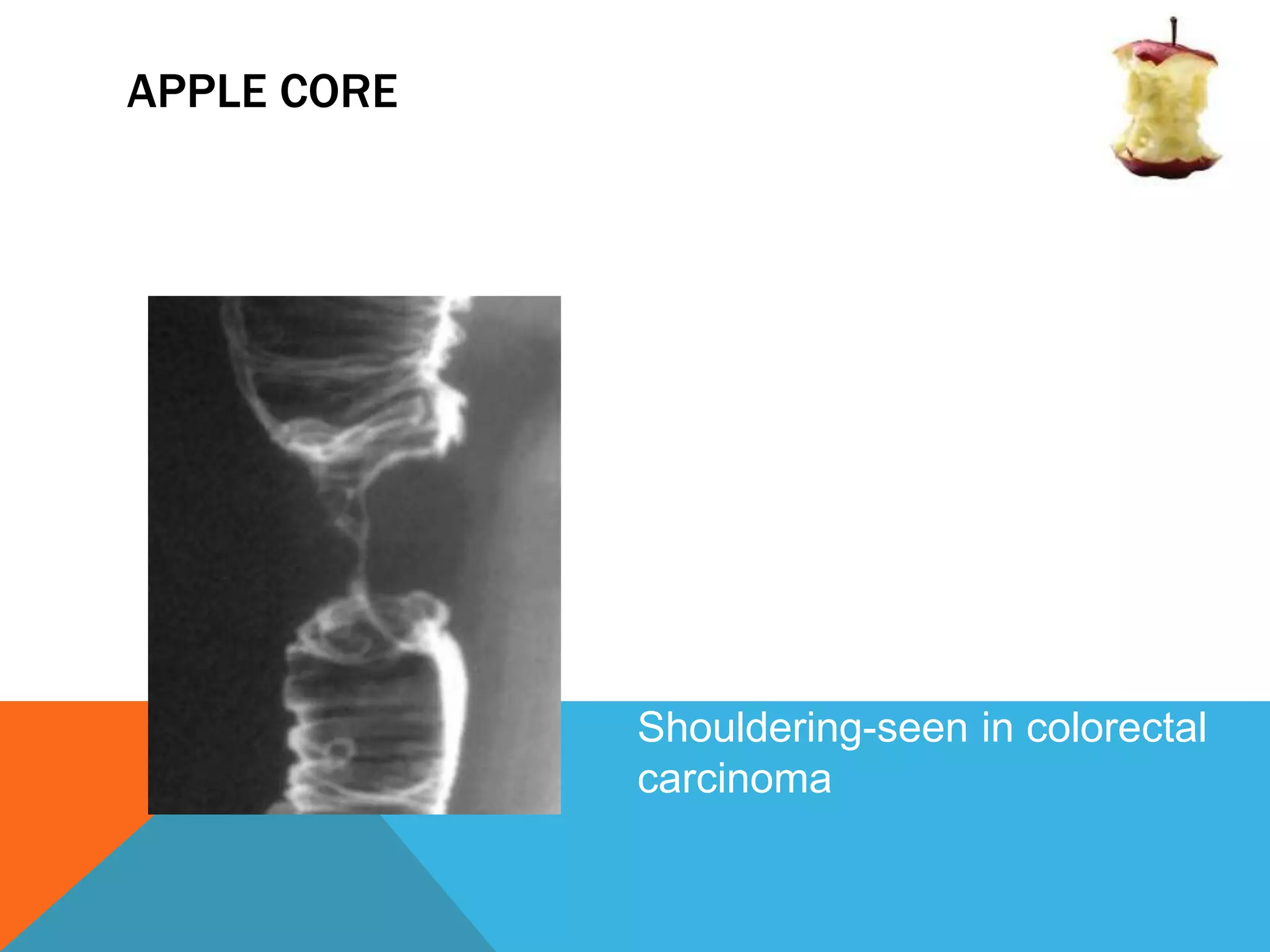 Barium enema ppt | PPTX