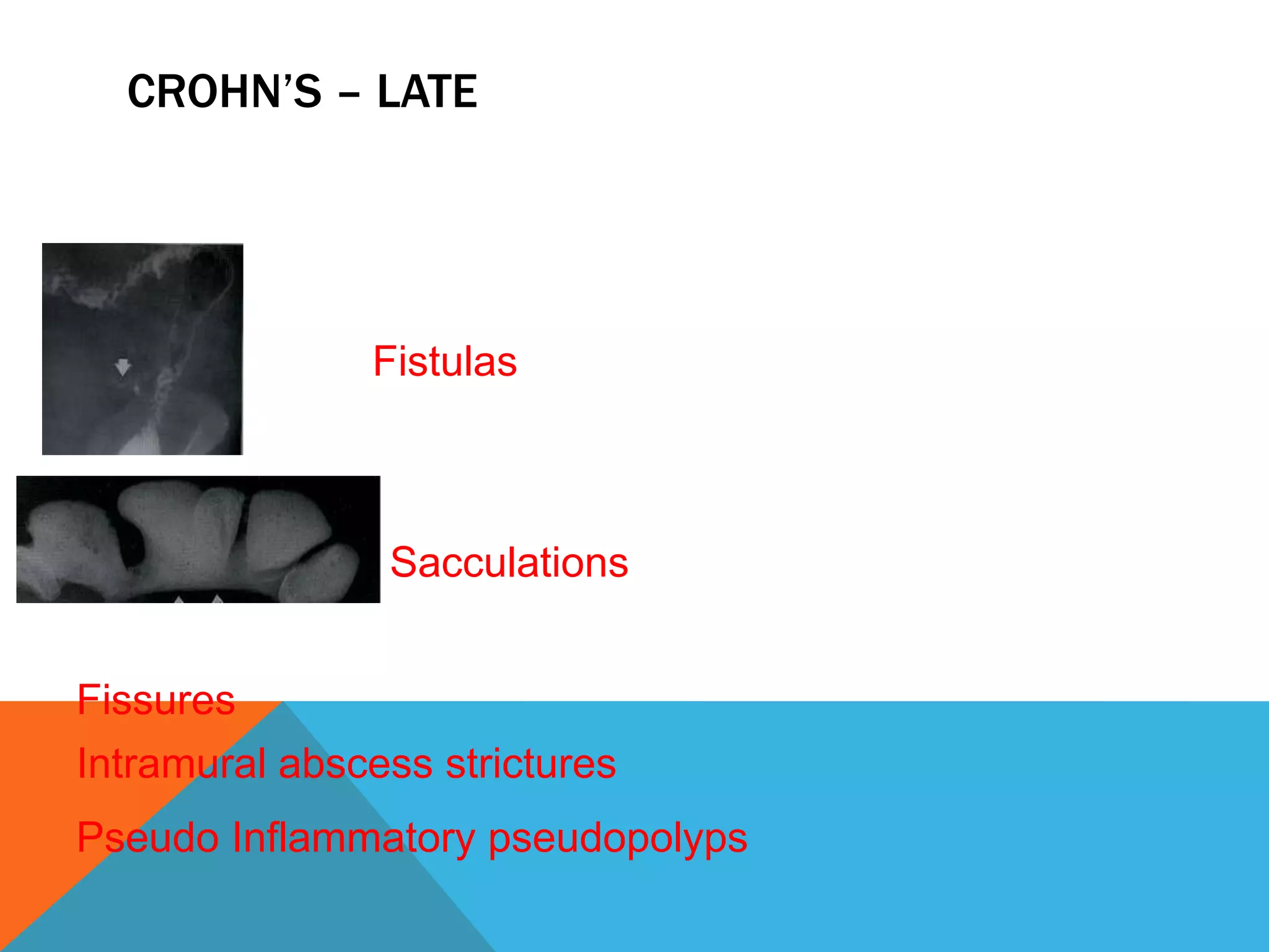 Barium enema ppt | PPTX