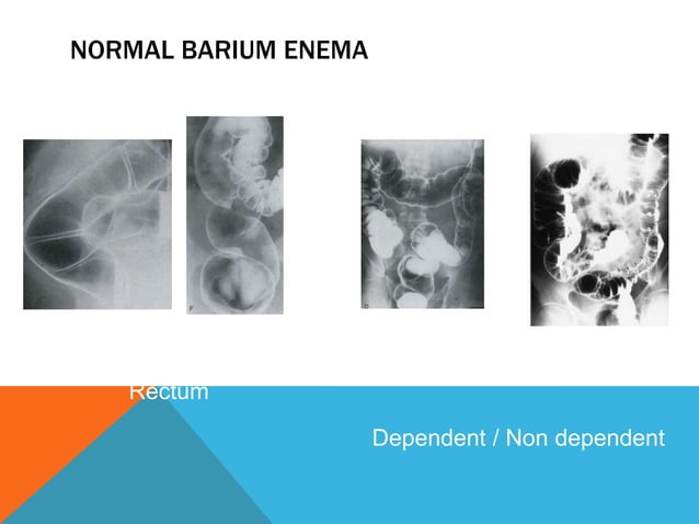 Barium enema ppt | PPT