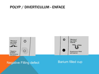 Barium enema ppt | PPTX