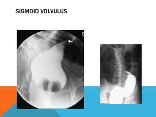 Barium enema ppt | PPTX