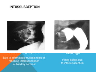 Barium enema ppt | PPTX | Digestive Disorders | Diseases and Conditions