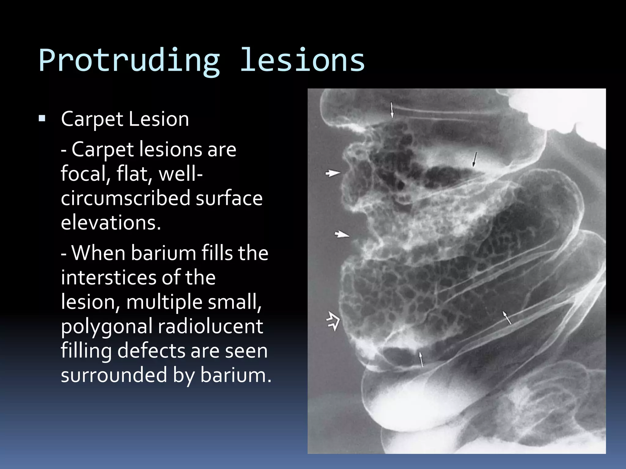 Barium enema procedure and patterns | PPTX