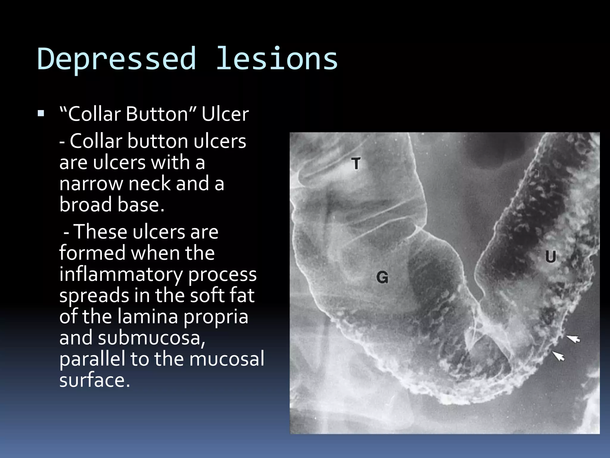 Barium enema procedure and patterns | PPTX