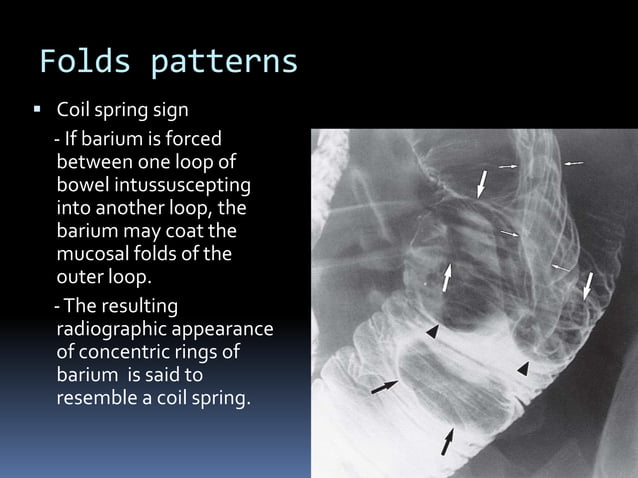Barium enema procedure and patterns | PPTX | Digestive Disorders ...
