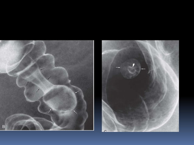 Barium enema procedure and patterns | PPTX | Digestive Disorders ...