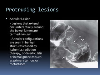 Barium enema procedure and patterns | PPTX