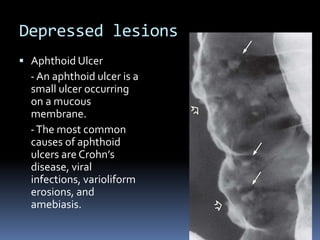 Barium enema procedure and patterns | PPTX