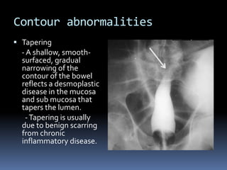 Barium enema procedure and patterns | PPTX
