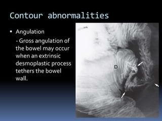 Barium enema procedure and patterns | PPTX