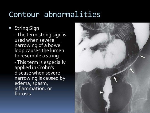 Barium enema procedure and patterns