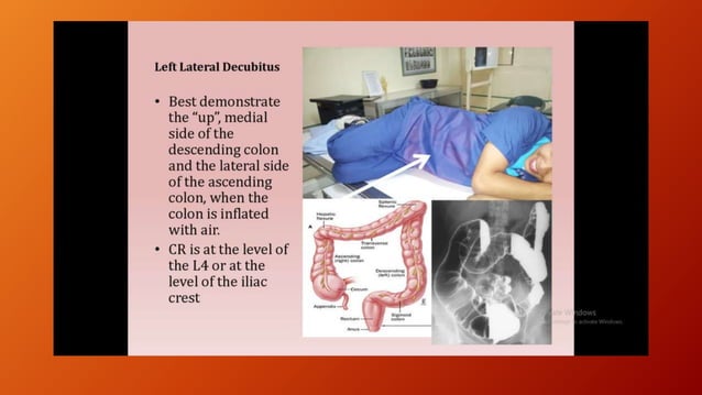 Barium enema by debajyoti | PPTX | Digestive Disorders | Diseases and ...