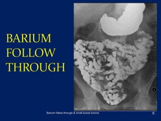 Barium follow through and small bowel enema sahara mahato | PPT
