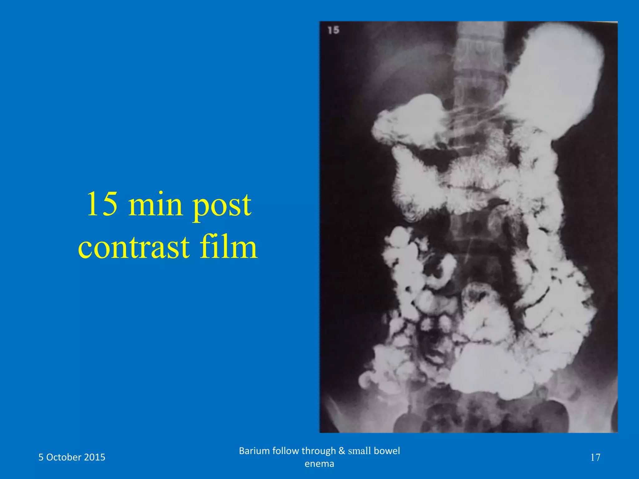 Barium follow through & small bowel enema ranju | PPTX