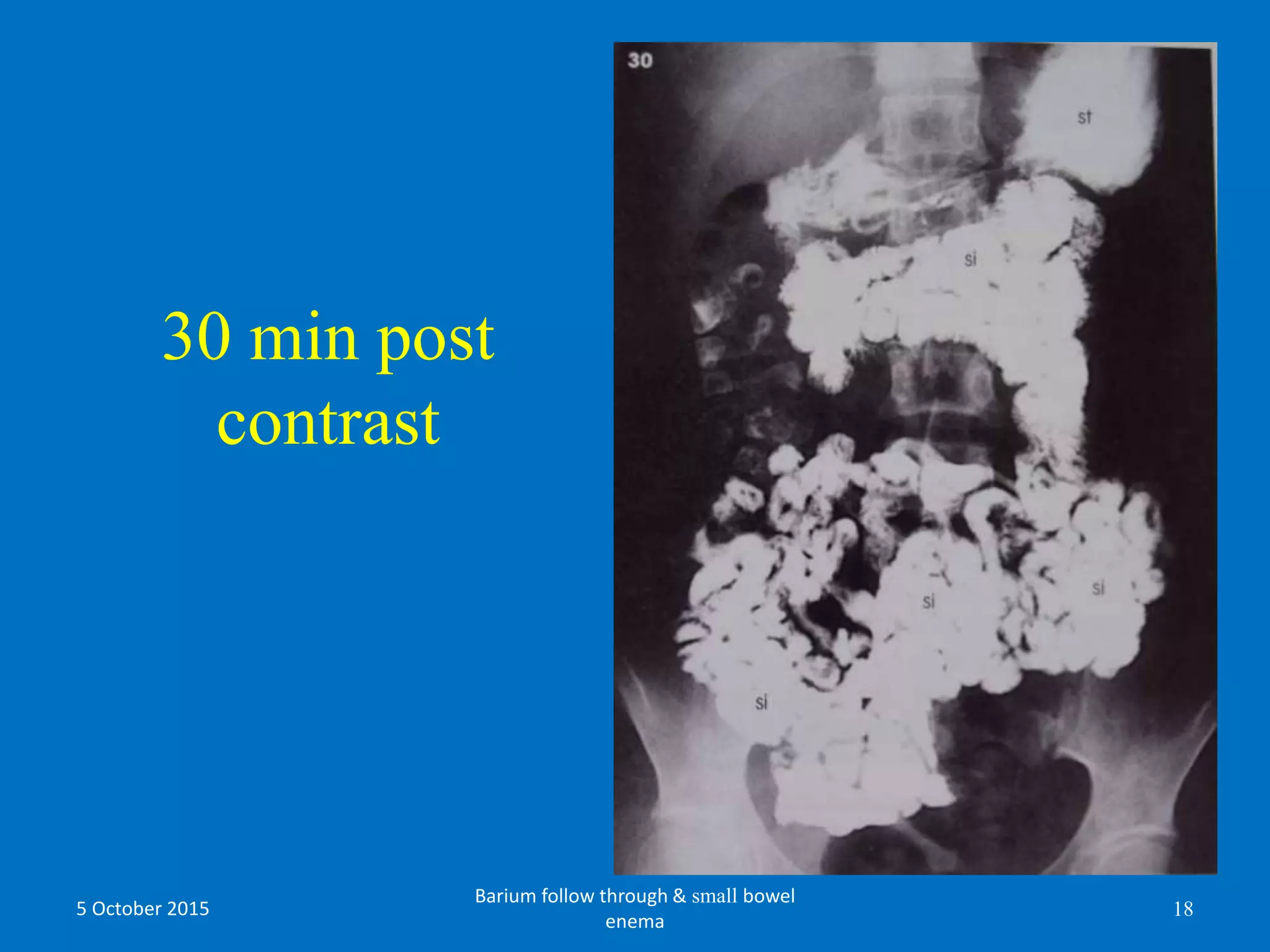 Barium follow through & small bowel enema ranju | PPTX